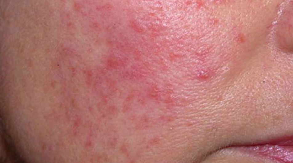 rougeur-visage-soin-huile-framboise | La beauté au naturel