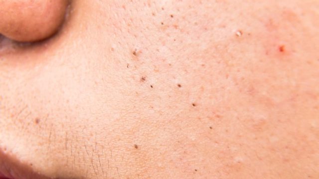 Peau grasse : cause et traitements naturels