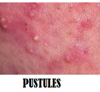 Pustules | La beauté au naturel