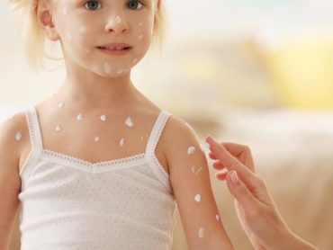 Lotion calamine : c’est quoi ? Comment en faire par soi-même