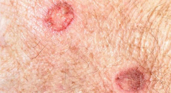 Verrues sur le Visage : Traitements Naturels et Prévention