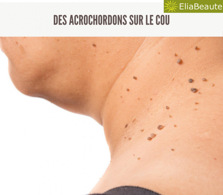Acrochordons: remèdes naturels pour les éliminer et prévention