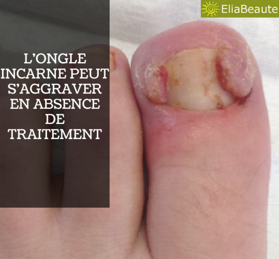 Guérir, prévenir les ongles incarnés: le tout naturellement