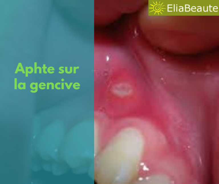 Aphte : qu'est-ce que c'est et comment le soigner