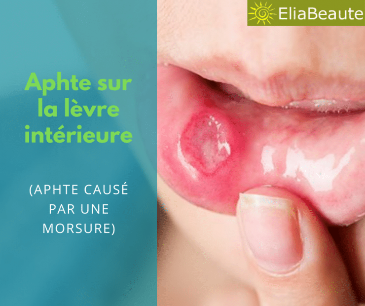 Aphte : qu'est-ce que c'est et comment le soigner