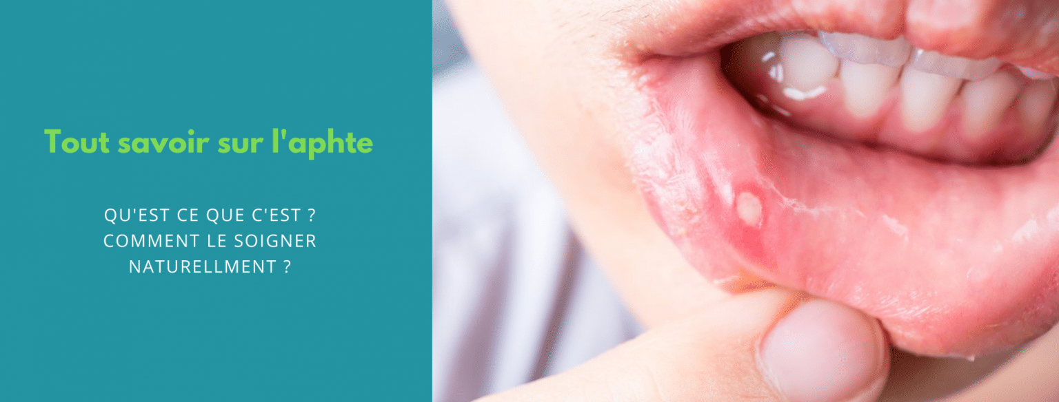 Tout savoir sur l’aphte | La beauté au naturel