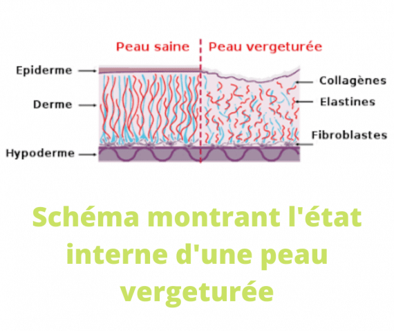 Vergeture, comment y remédier