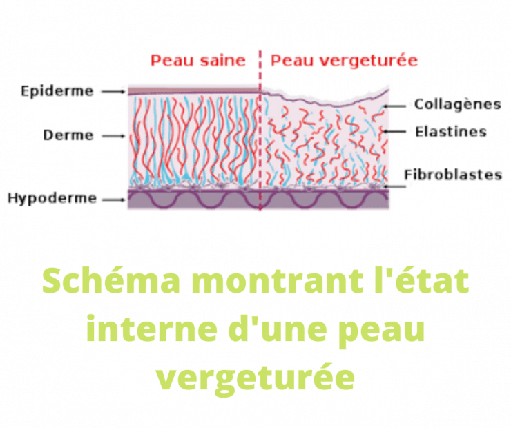 Vergeture, comment y remédier